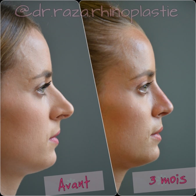 Rhinoplastie sur un nez trop gros | Spécialiste du nez | Dr Raza | 83