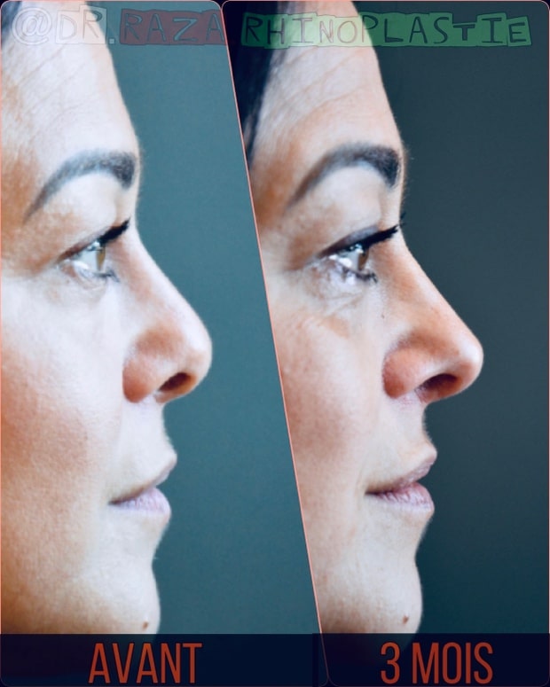 Rhinoplastie sur un nez trop petit | Spécialiste du nez | Dr Raza | 83