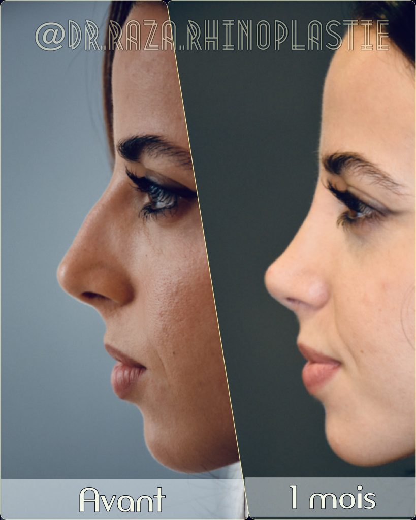 Rhinoplastie de préservation à Toulon | Dr Raza | Spécialiste Nez