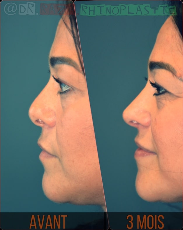 Rhinoplastie sur un nez trop petit | Spécialiste du nez | Dr Raza | 83